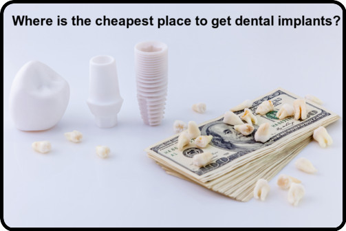 Where Is The Cheapest Place To Get Dental Implants