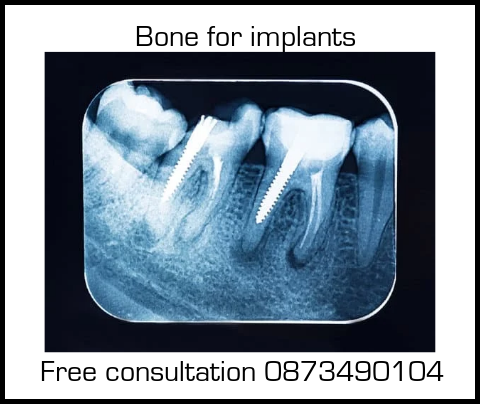 Bone for dental implants - Professional Affordable Dental Treatments ...